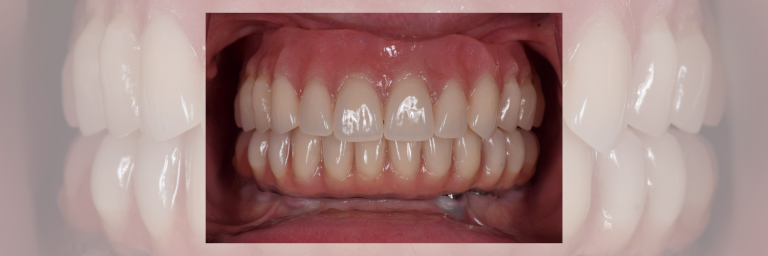 Socket shield therapy: when, where & how? - ITI Blog