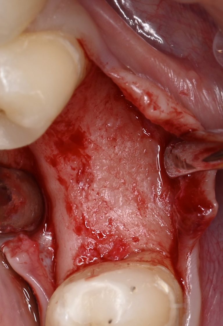 Static computer-assisted implant surgery in daily clinical practice ...