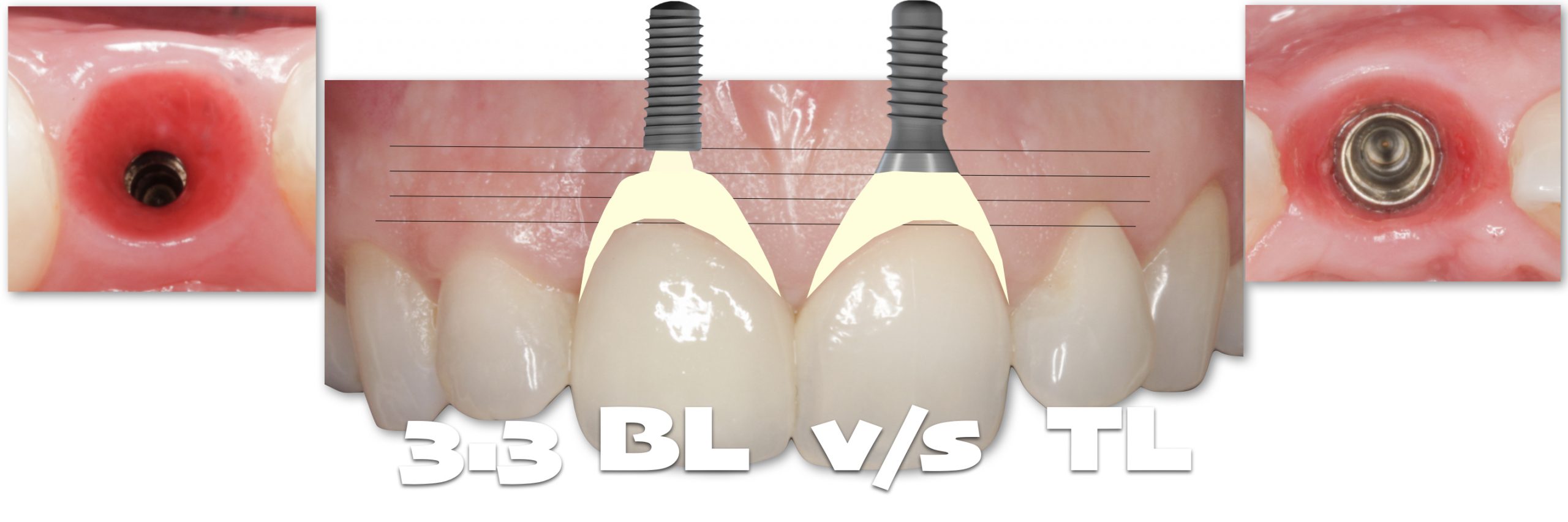 Tissue Level Implants in the Esthetic Zone - ITI Blog