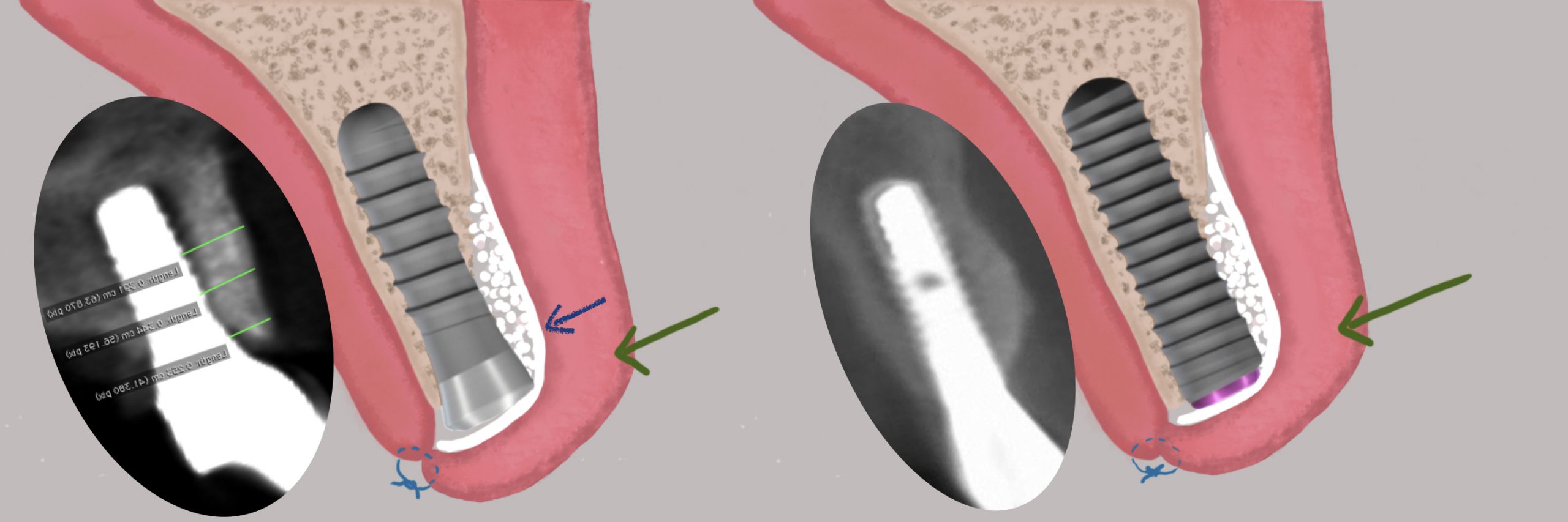 Tissue Level Implants in the Esthetic Zone - ITI Blog