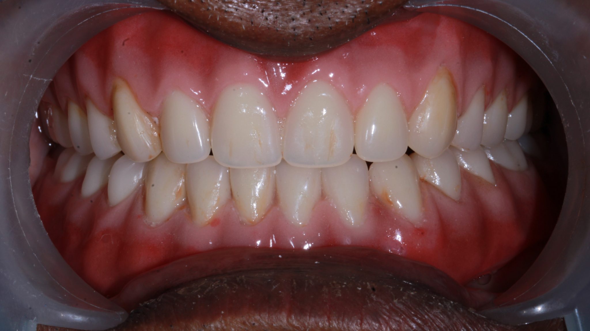 Implant-supported overdentures: The unsung hero of full arch ...