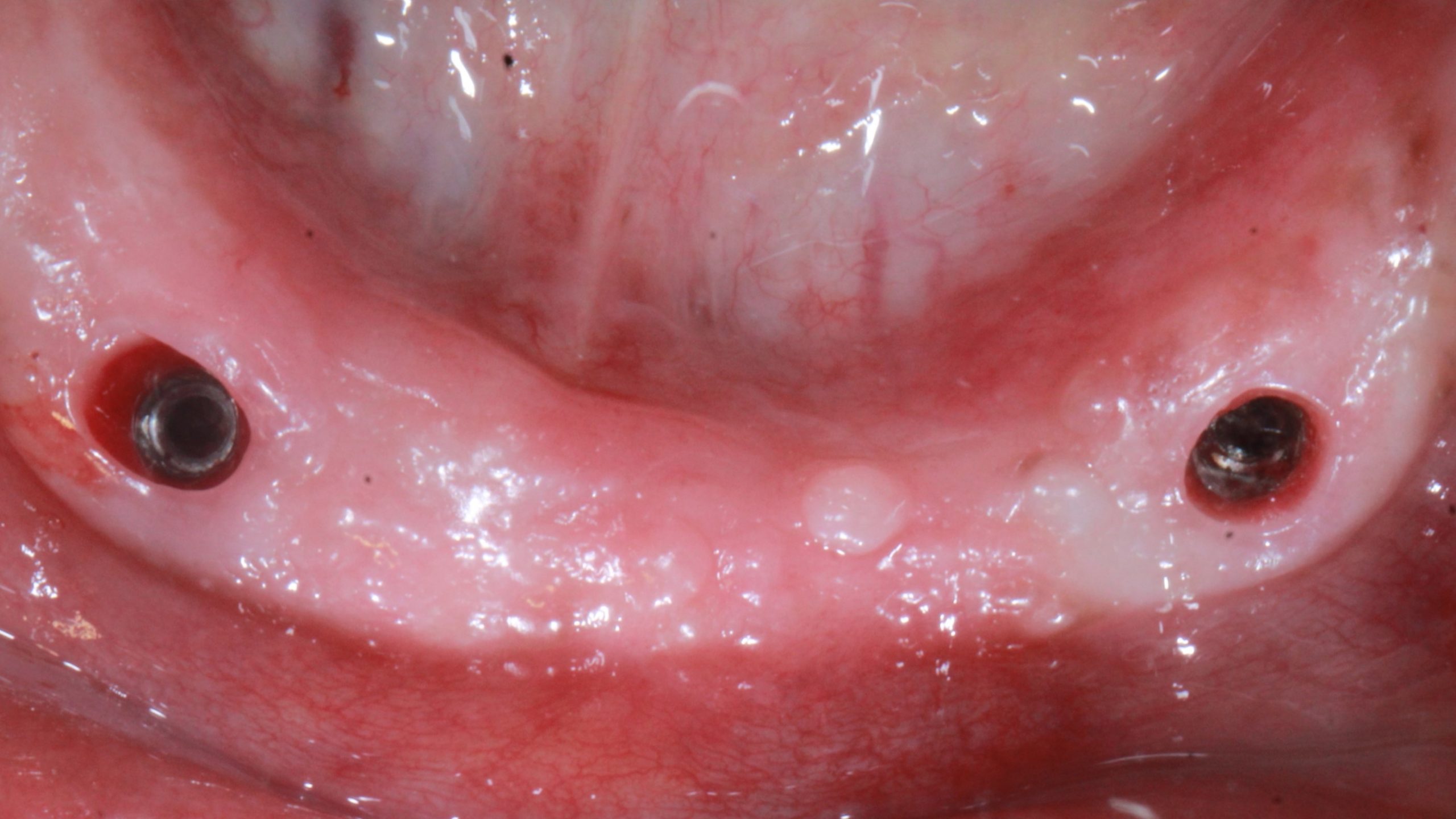 Implant-supported overdentures: The unsung hero of full arch ...