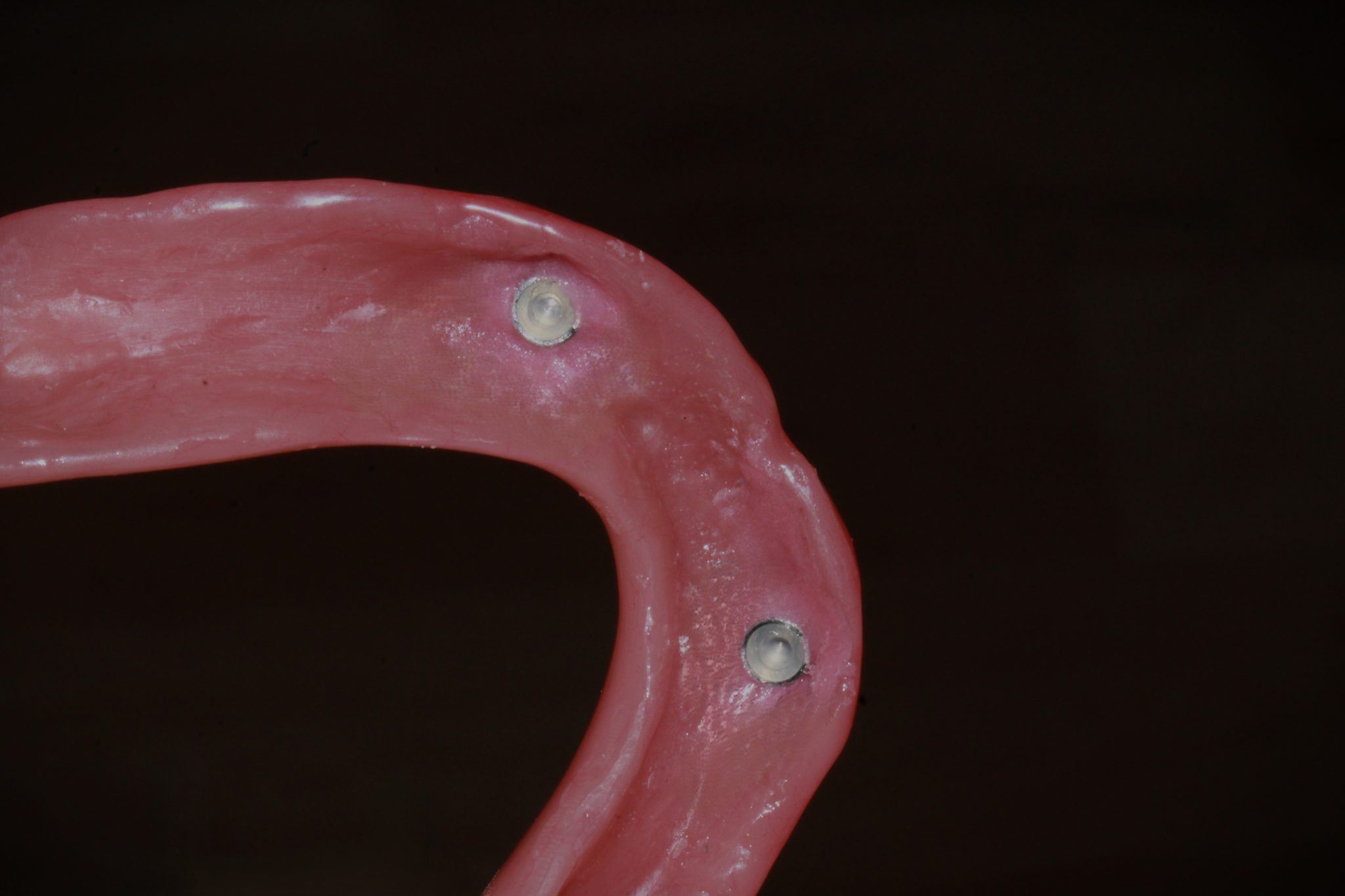 Implant-supported overdentures: The unsung hero of full arch ...