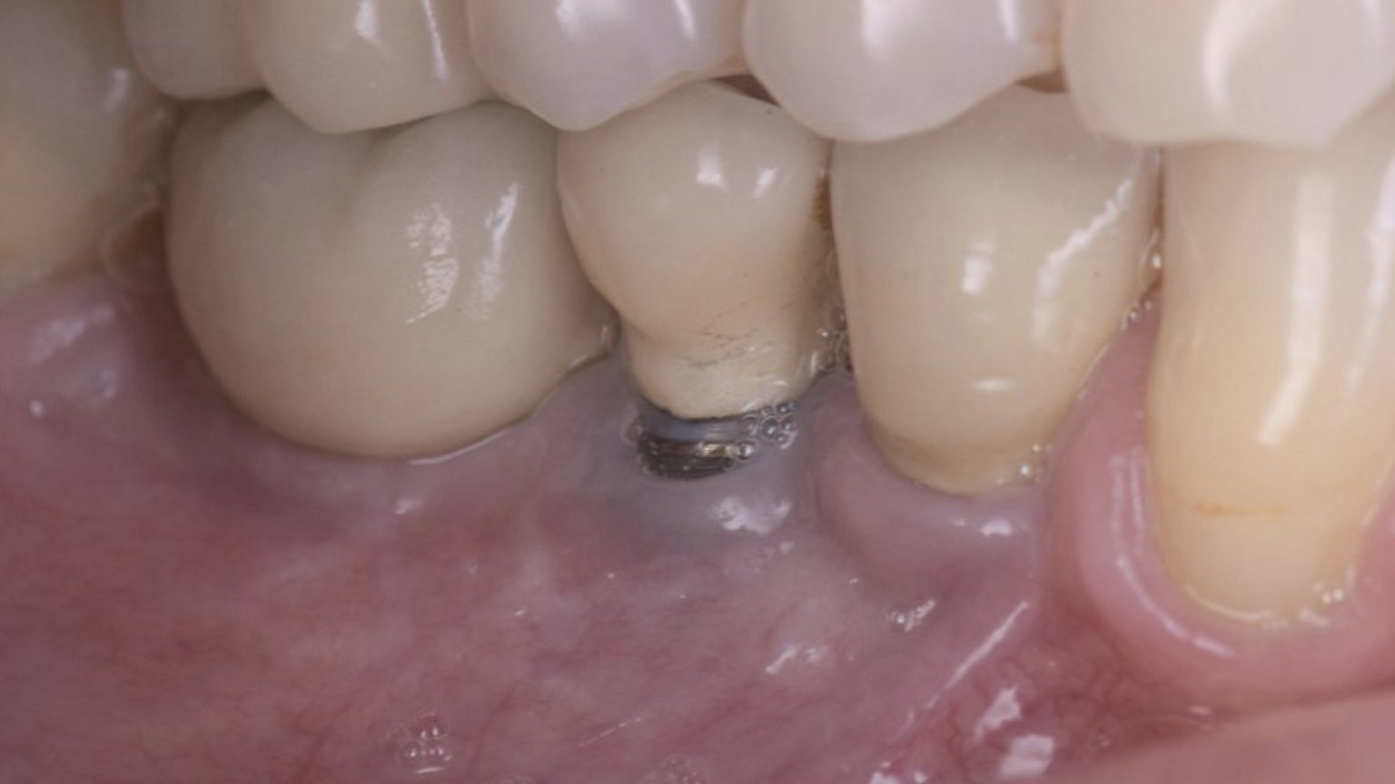 Hard- and soft-tissue deficiencies around dental implants: How to treat ...