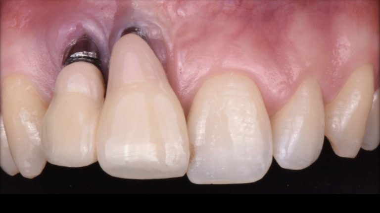 Hard- and soft-tissue deficiencies around dental implants: How to treat ...