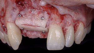 Hard- and soft-tissue deficiencies around dental implants: How to treat ...