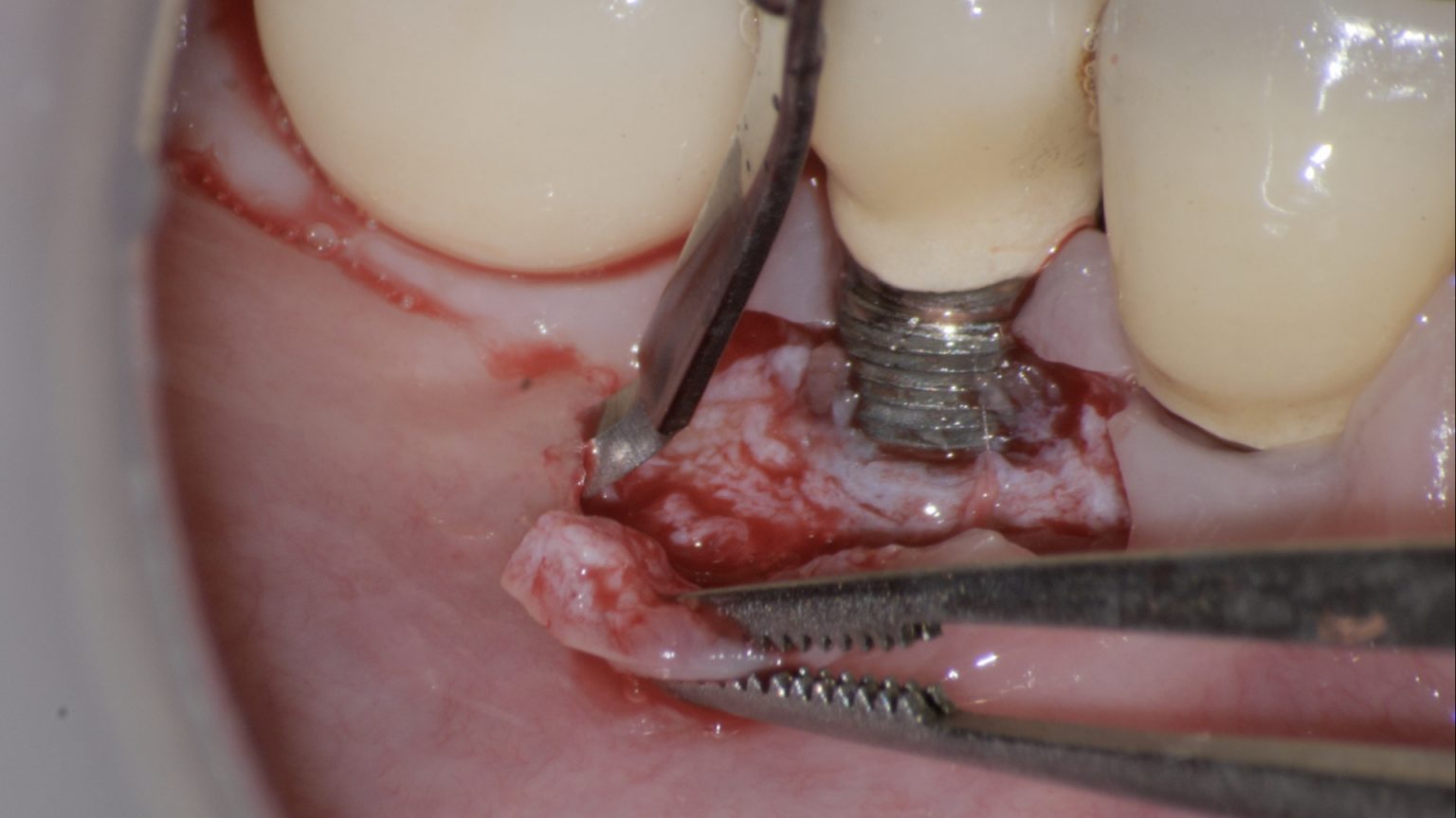 Hard- and soft-tissue deficiencies around dental implants: How to treat ...