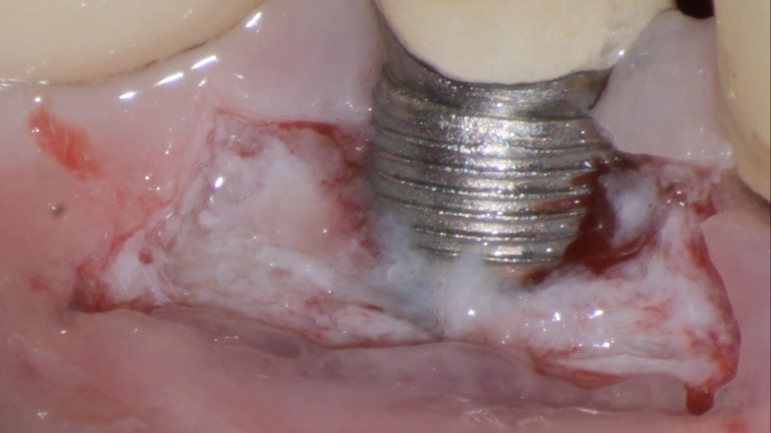 Hard- and soft-tissue deficiencies around dental implants: How to treat ...