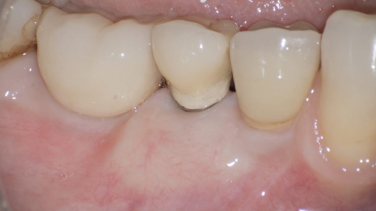 Hard- and soft-tissue deficiencies around dental implants: How to treat ...