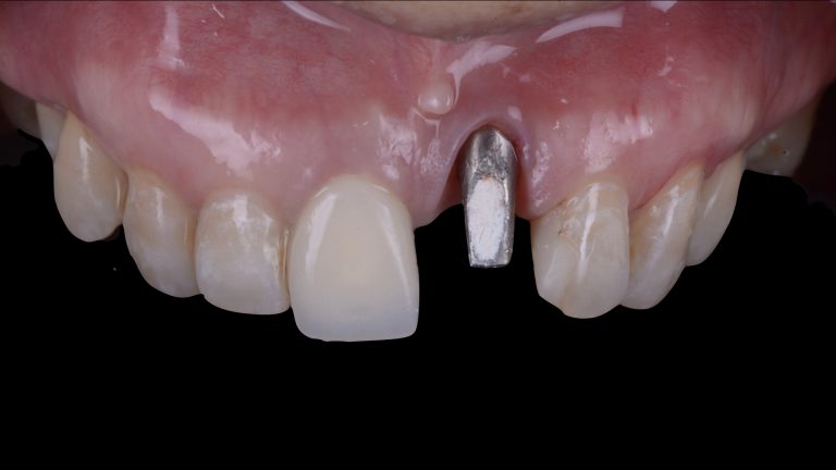Hard- and soft-tissue deficiencies around dental implants: How to treat ...