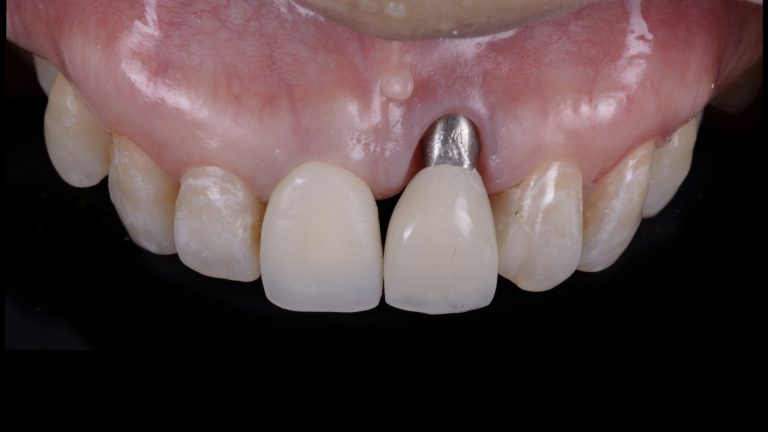 Hard- and soft-tissue deficiencies around dental implants: How to treat ...