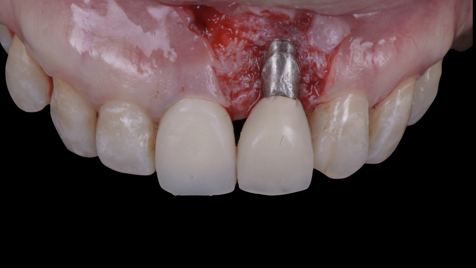 Hard- and soft-tissue deficiencies around dental implants: How to treat ...