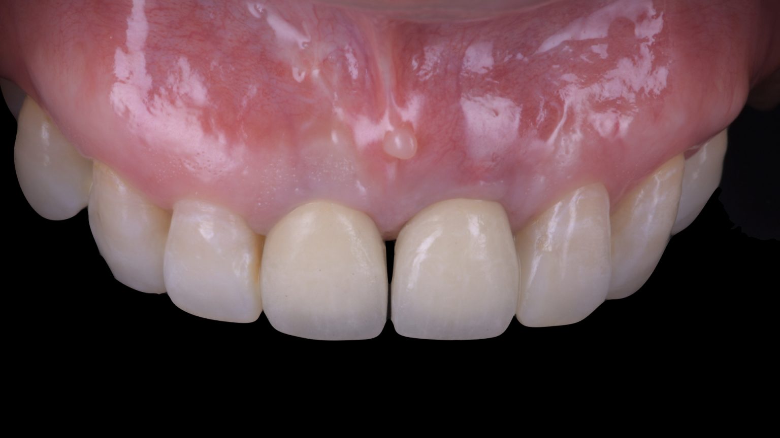 Hard- and soft-tissue deficiencies around dental implants: How to treat ...