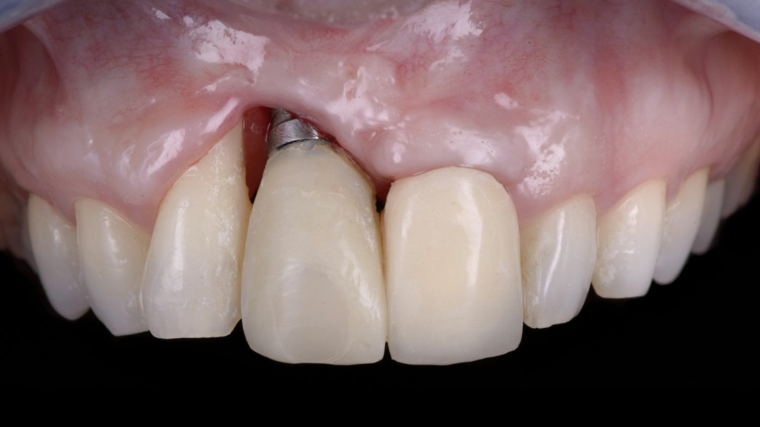 Hard- and soft-tissue deficiencies around dental implants: How to treat ...