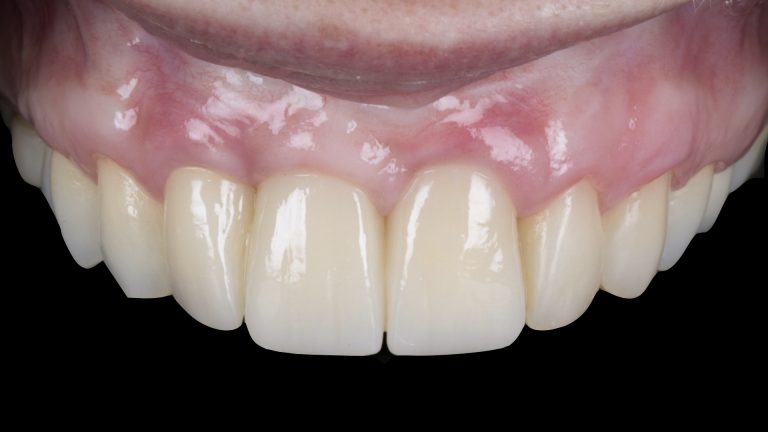 Hard- and soft-tissue deficiencies around dental implants: How to treat ...