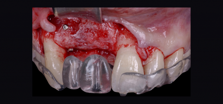 A Safe, Predictable and Efficient Way to Create a Lateral Window during ...
