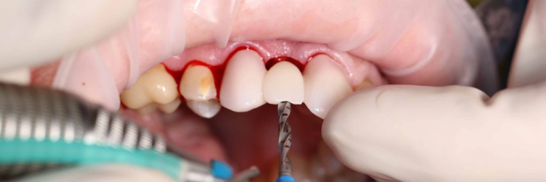 Interocclusal space assessment for full-arch implant-supported ...