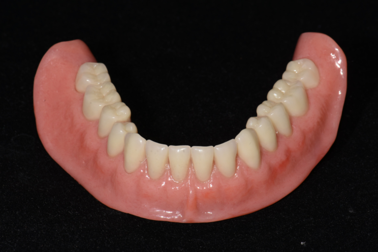 Mini implants as retainers for mandibular overdentures - ITI Blog
