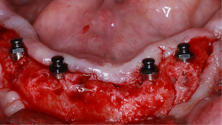 Mini implants as retainers for mandibular overdentures - ITI Blog