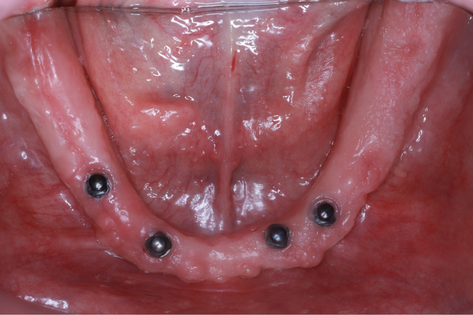 Mini implants as retainers for mandibular overdentures - ITI Blog