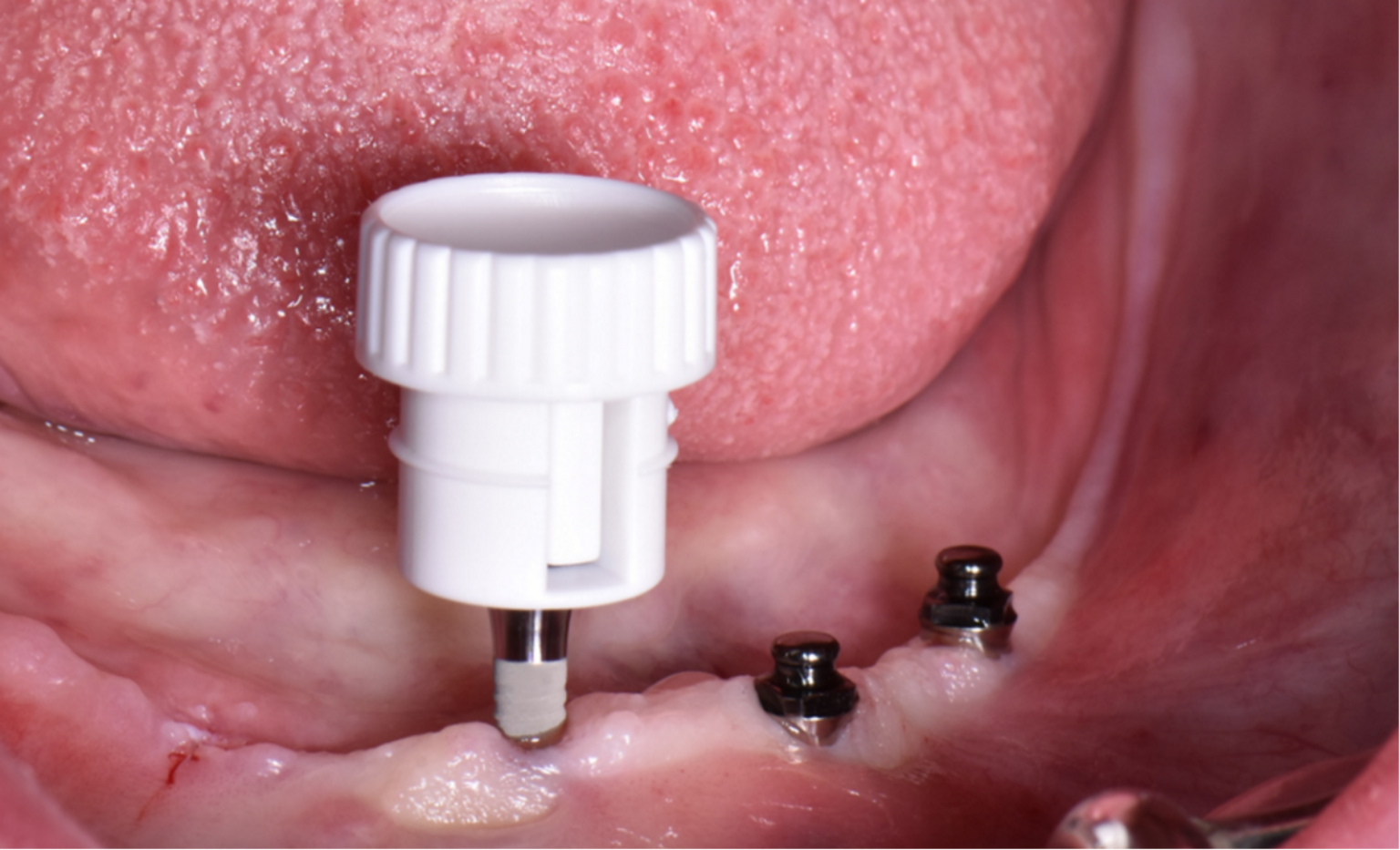 Mini implants as retainers for mandibular overdentures - ITI Blog
