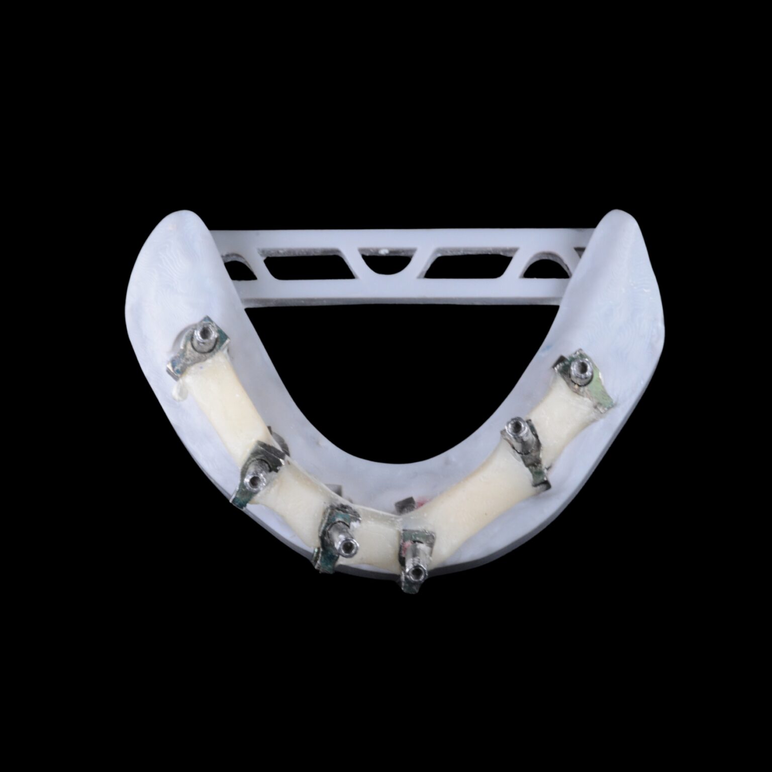 Verification Jigs: The Key to an Accurate Fit for Implant-Supported ...