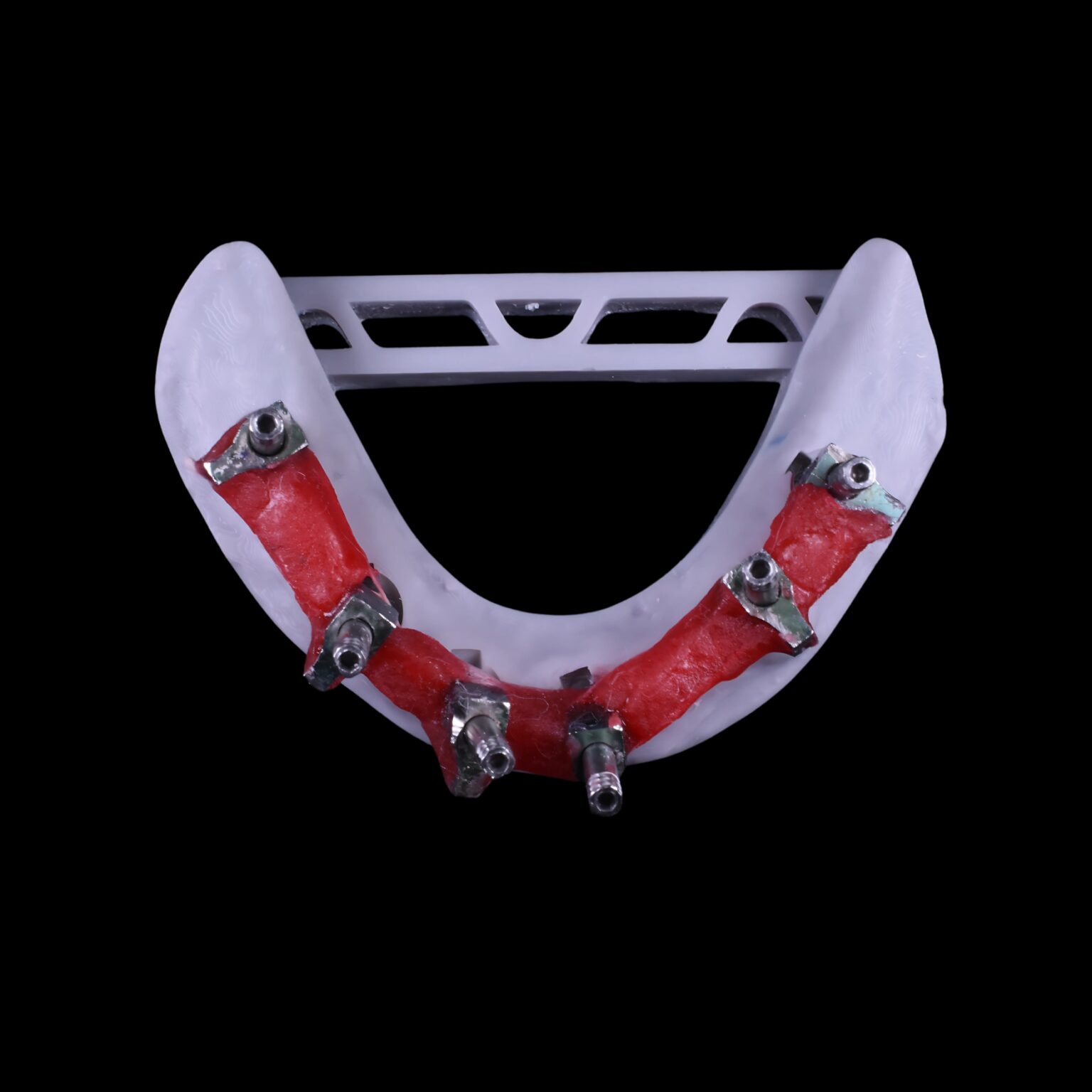 Verification Jigs: The Key to an Accurate Fit for Implant-Supported ...