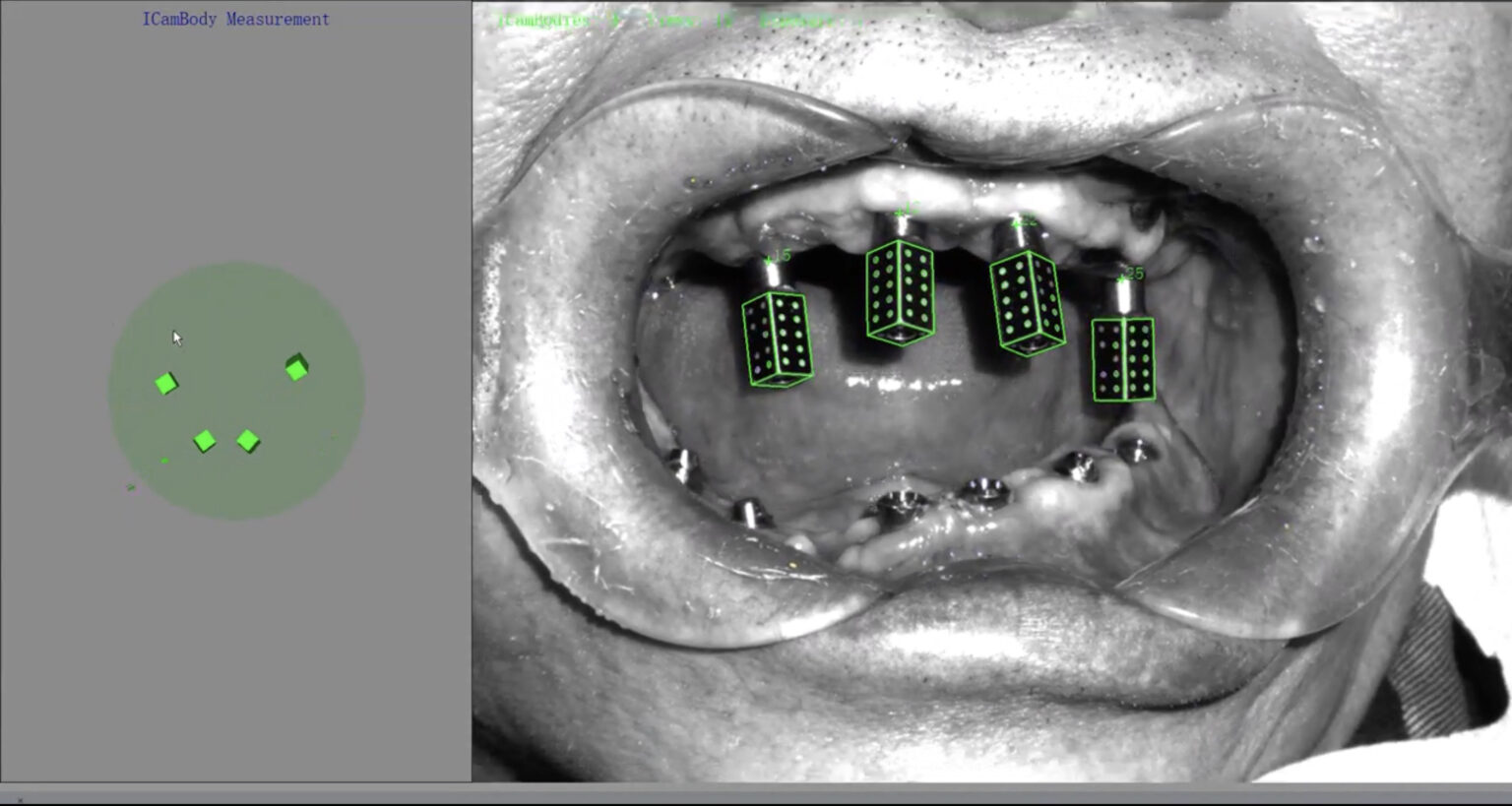 Accuracy of Photogrammetry-Based Systems in Capturing Complete-Arch ...