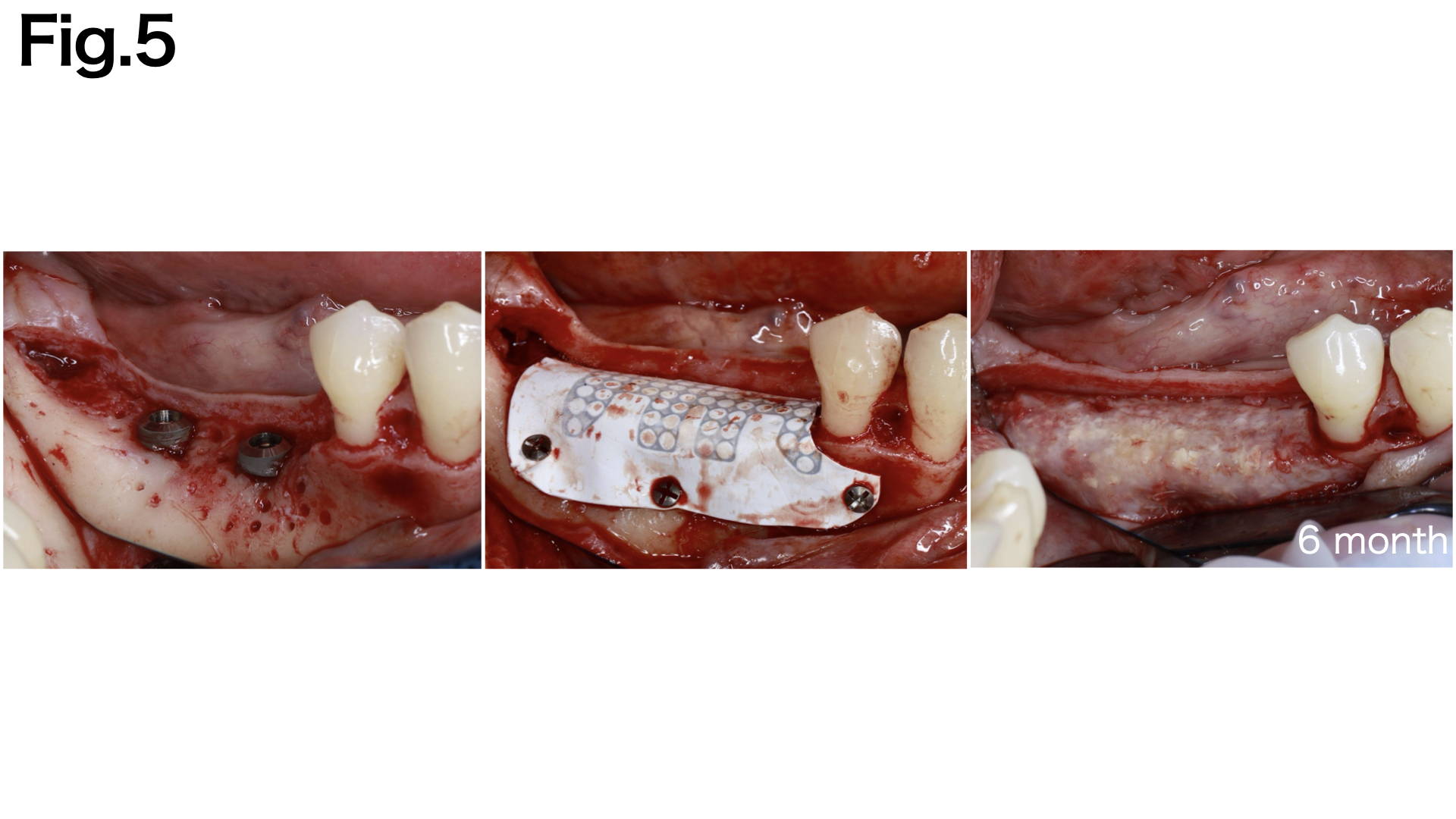 Bone defect morphology and appropriate barrier membrane selection - ITI ...
